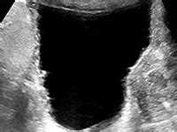 Bladder Ultrasound UDS