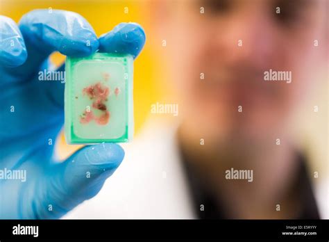 Tumor Sample Taken From Patients In The Anatomopathology Diagnosis
