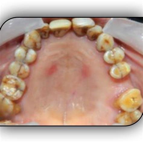 [pdf] Management Of Fractured Mandibular Single Complete Denture