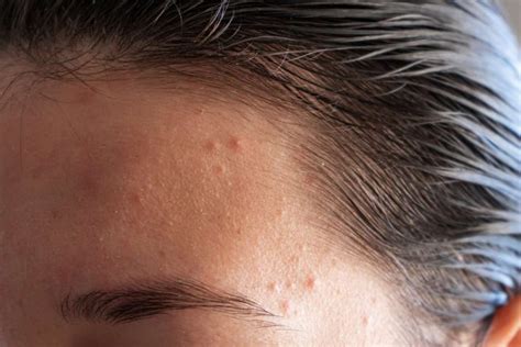 How To Get Rid Of Forehead Acne Her Beauty Plug