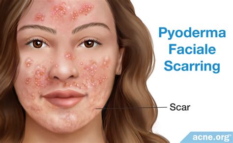What Is Pyoderma Faciale Understanding The Condition