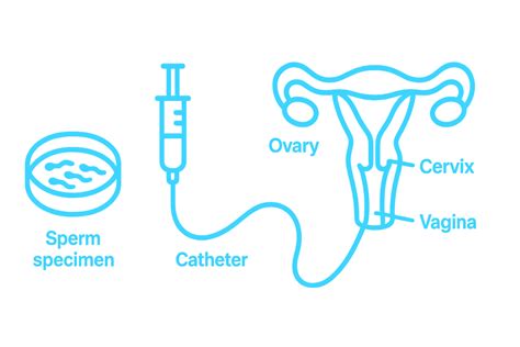 Intrauterine Insemination Iui In Malaysia Metro Ivf Fertility Centre