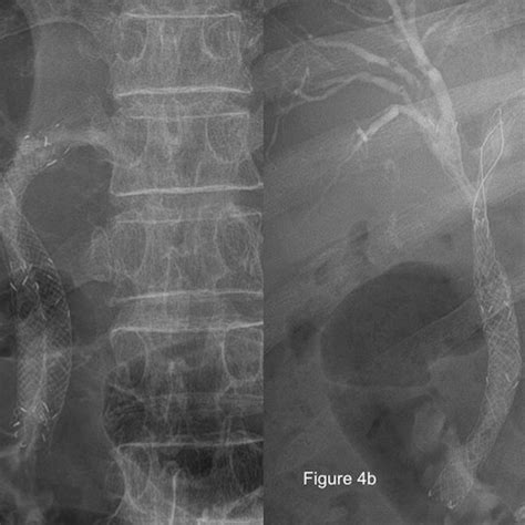 Bismuth Classifications Of Cholangiocarcinoma Download Scientific Diagram