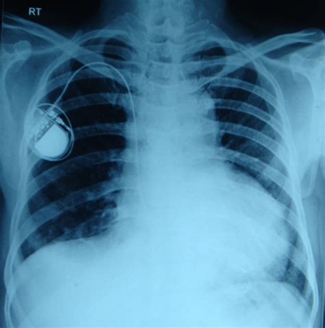 Single Chamber Pacemaker On Chest X Ray Pa Cardiology X Ray Quiz 7