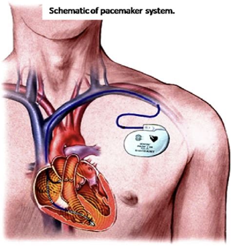 Diagram Illustrating The Autonomous Pacemaker System [62] Download