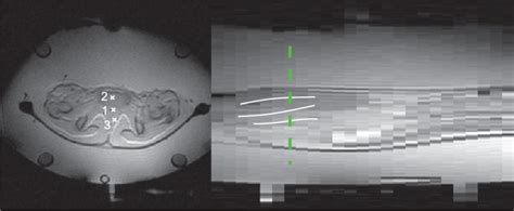 Left Patient Anatomy From The Transverse Plane Showing The Probe Download Scientific Diagram