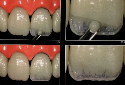 Class Iv Composite Silicone Guide Technique Dental Esthetics