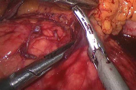 The Pancreas And Its Role In Sugar Metabolism Laparoscopic Md