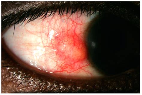 Episcleritis Vs Scleritis