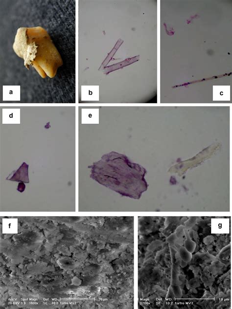 A Dental Calculus On A Molar Of The Subject Mv15 Etruscan Celtic