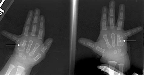 Metacarpal Synostosis Hand Surgery Resource