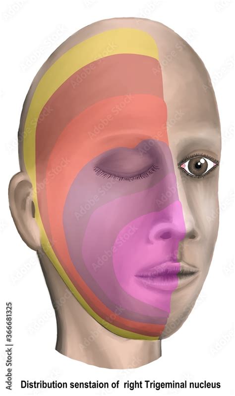 The Onion Skin Pattern Of Facial Sensation Regarding To Right Trigeminal Nucleus Lesion In Brain