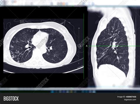 What Is A Chest Ct Used To Diagnose At Esperanza Bruns Blog