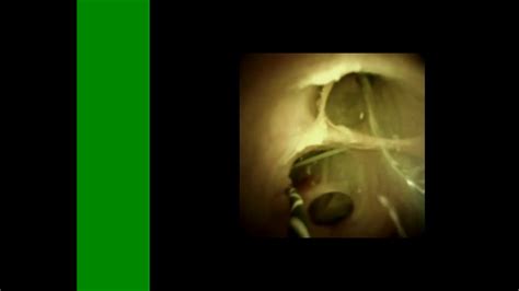 Alessandro Mussetto On Linkedin Ercp Spyglass Biliaryendoscopy