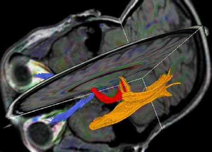 3d Dti Reconstruction Of The Human Visual System Including Optic