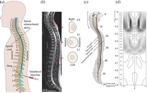 Effects Of Buoyancy On The Dispersion Of Drugs Released Intrathecally