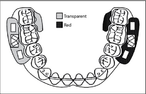 Figure 1 From Remineralizing Efficacy Of A Cpp Acp Cream On Enamel Caries Lesions In Situ