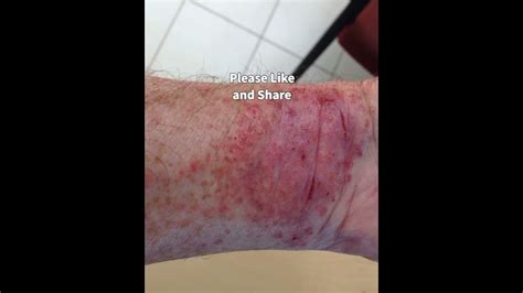 Toxic Plants Can Cause Phytophotodermatitis Shorts Youtube