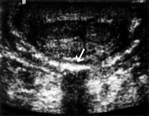 Calcification Of The Epididymis And The Tunica Albuginea Of The Corpora