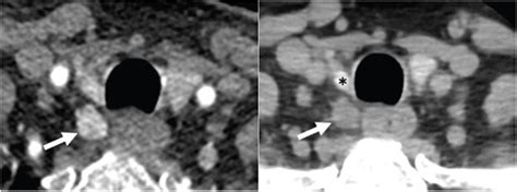 Opportunistic Ct Shows Promise For Identifying Undiagnosed Primary