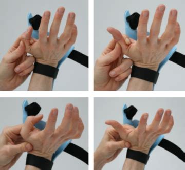 Extensor Tendon Injuries Of The Hand Physiopedia