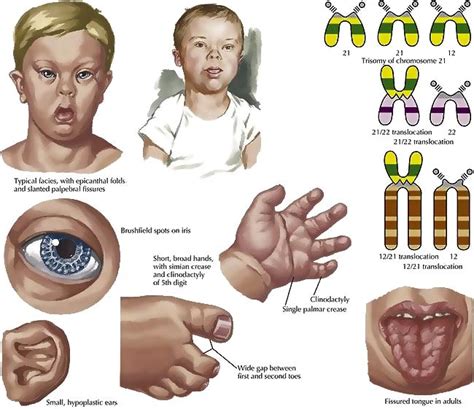 علل بروز اختلال سندروم داون در تولد نوزاد