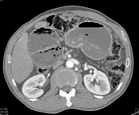 Obstruction Of The Gastrojejunostomy Loop Small Bowel Case Studies Ctisus Ct Scanning