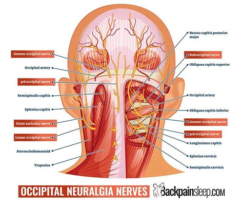 Occipital Neuralgia Artofit