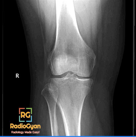 Schatzker Classification Of Tibial Plateau Fractures Radiogyan