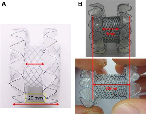 The Newly Designed Lumen Apposing Metal Stent Spaxus Taewoong Medical