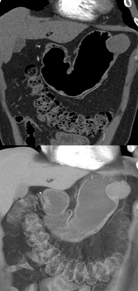 Gastrointestinal Learning Modules Ct Scanning