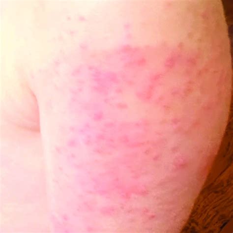 A 7 Year Old Girl Developed A Pruritic Erythematous Indurated Papular