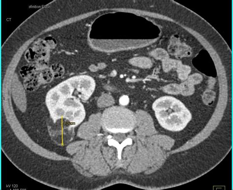 Intraductal Papillary Mucinous Neoplasm Ipmn Tail Of Pancreas And Incidental Right Renal