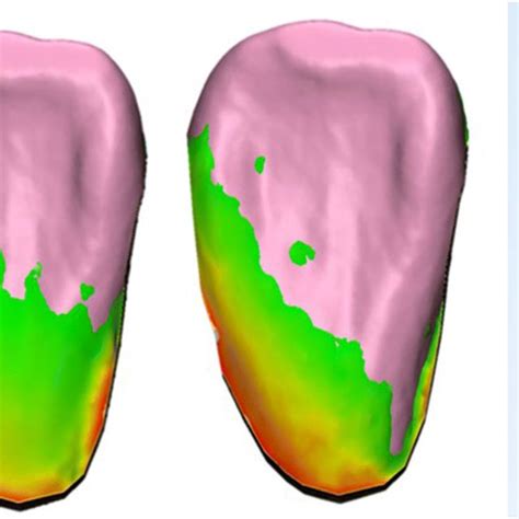 color deviation map shows positive deviations in proximal and cervical