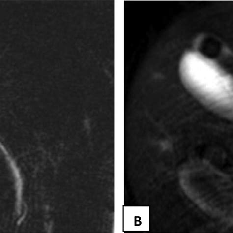 A Two Separate Gallbladders B One Gallbladder With Multiple