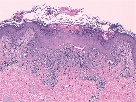 Lichenoid Chronic Graft Vs Host Disease Following Blaschko Lines