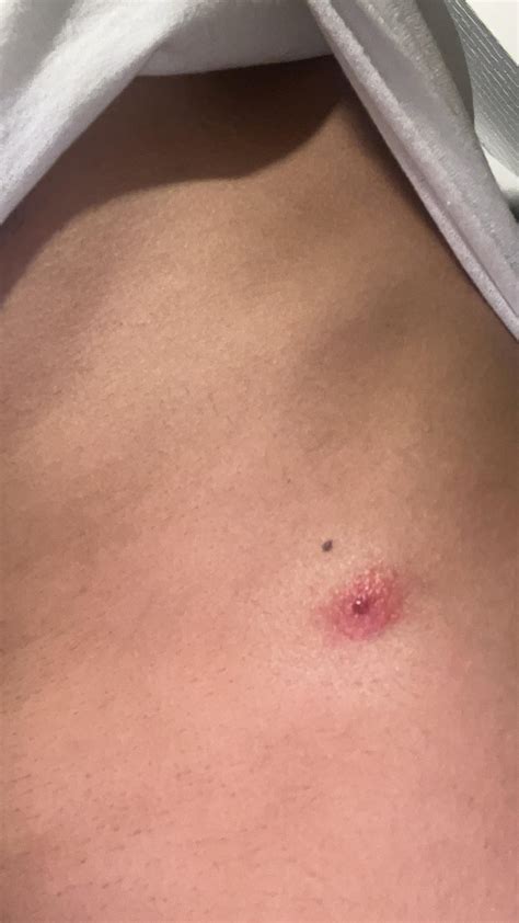 Is This A Hiv Rash Unprotected Sex Two Weeks Ago No Other Symptoms R Hiv