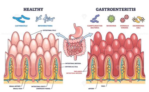 Gastroenteritis Or Stomach Flu Microbiological Explanation Outline