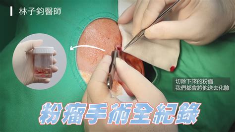 粉瘤手術全紀錄 極緻美型·文心極緻美型皮膚科診所整形手術 林子鈞醫師：台中粉瘤粉瘤手術微創粉瘤粉瘤健保 Youtube