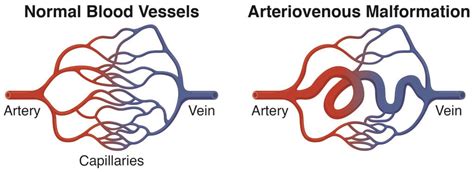 Arteriovenous Malformation Norelle Health