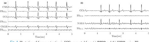 Figure 1 From Machine Learning For Ranking F Wave Extraction Methods In Single Lead Ecgs