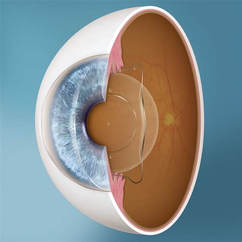 Implantable Collamer Lens Icl Technology Providence Eye