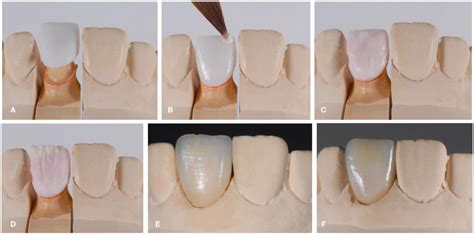 Metal Ceramic Crown Lab Procedure At Lois Toussaint Blog