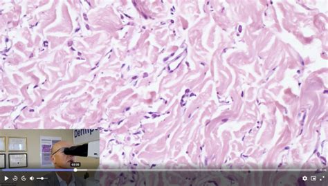 Unusual Septal Panniculitis Raising Differential Diagnosis