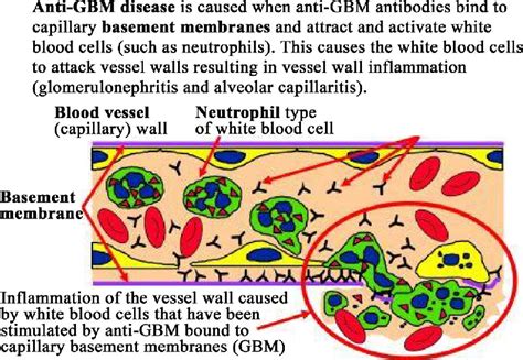 Inflammation Of Glomerular Basement Membrane Caused By Anti Gbm Download Scientific Diagram