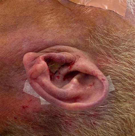 Post Auricular Dressings Dr Sean Flanagan
