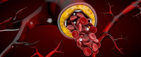 Hypercholesterolemia Vs Hyperlipidemia