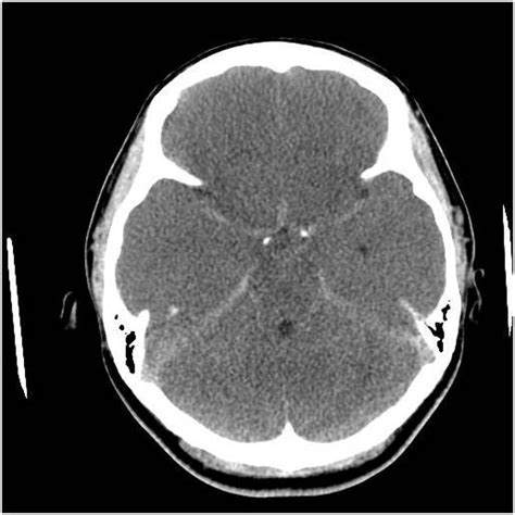 Tasty Morsels Of Em 061 Pseudo Sub Arachnoid Emergency Medicine Ireland