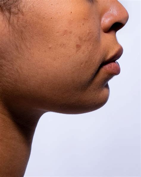 Post Inflammatory Hyperpigmentation What Is It