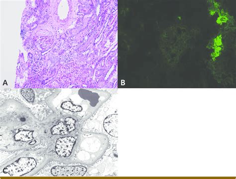 A Renal Biopsy Light Microscopy The Glomeruli Are Segmentally Download Scientific Diagram